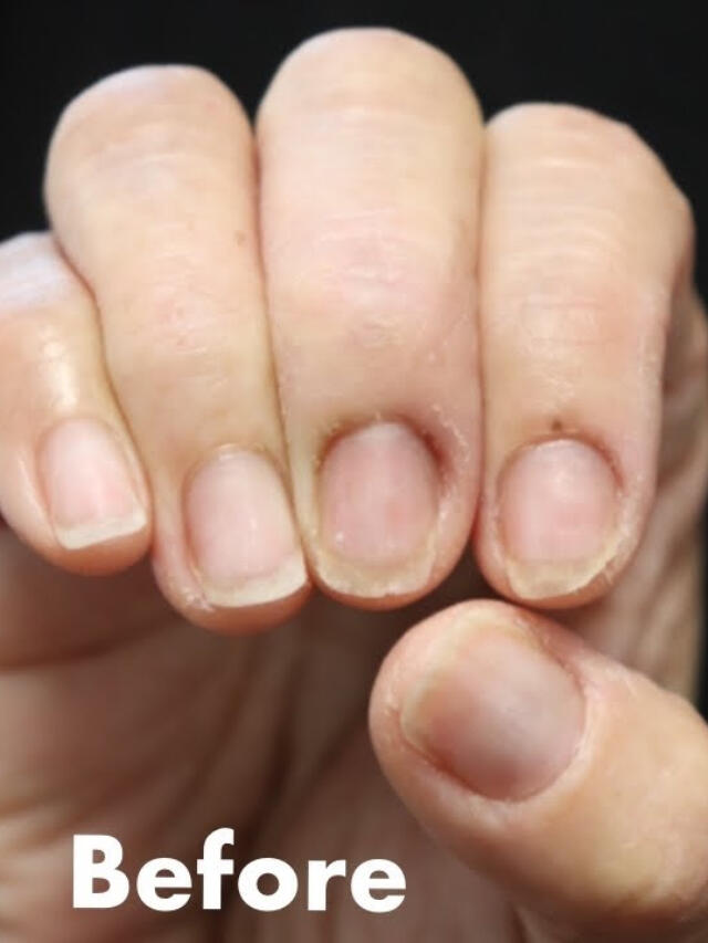 Learn about 10 Signs your body need Calcium - tfipost.in